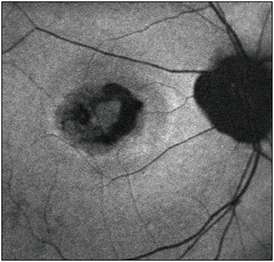 Retinal Physician | PentaVision