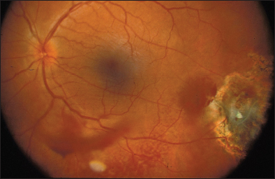 Retinal Physician | PentaVision