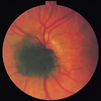 Retinal Physician | PentaVision