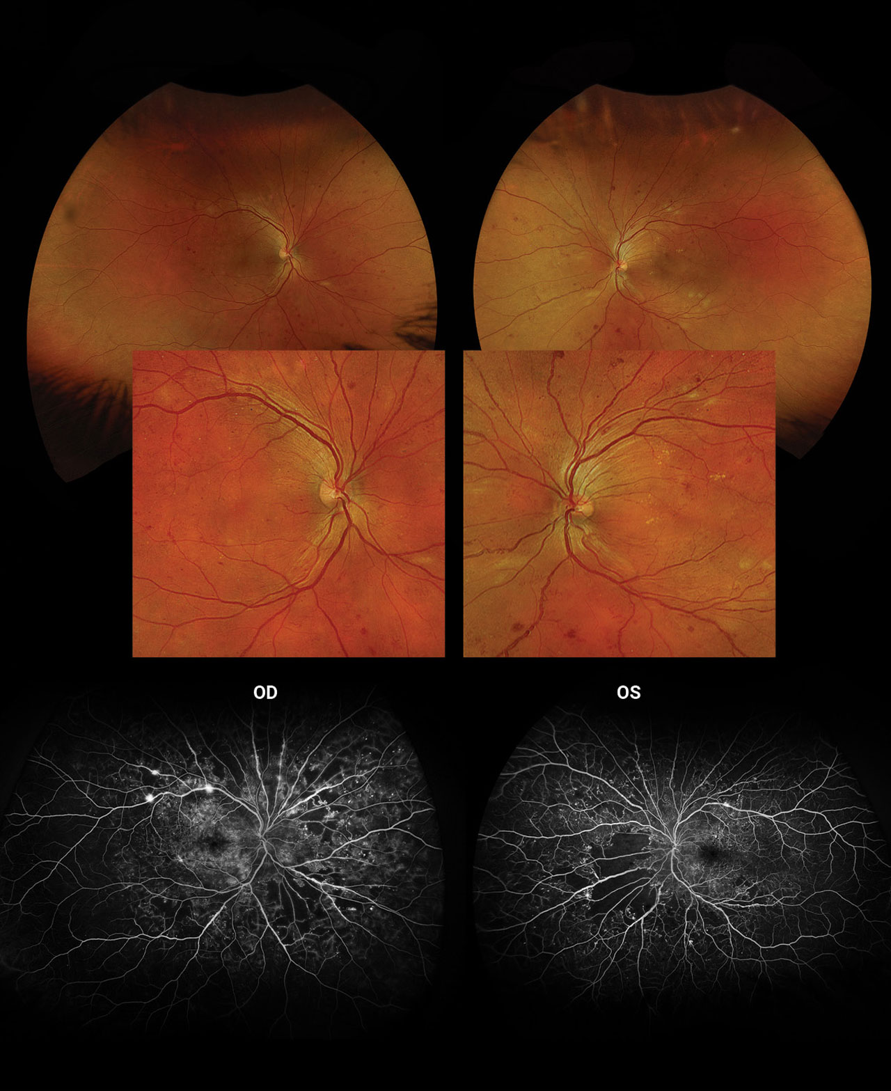 Ultra-Widefield Image of the Month | Retinal Physician