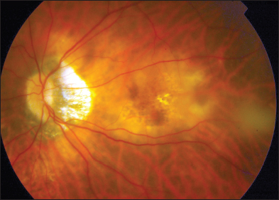 Retinal Physician | PentaVision