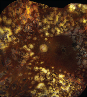 Retinal Physician | PentaVision