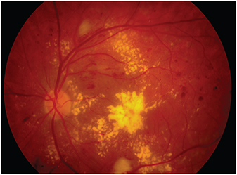 Retinal Physician | PentaVision