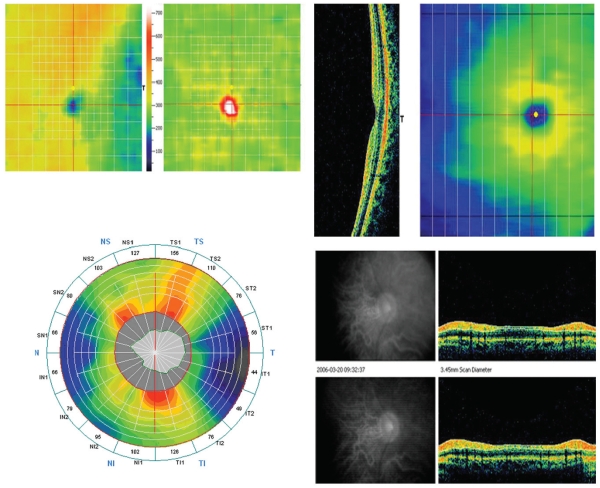 Retinal Physician | PentaVision