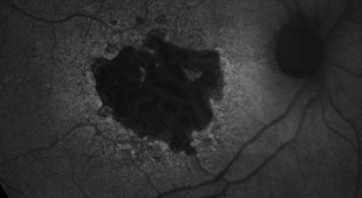 Retinal Physician | PentaVision