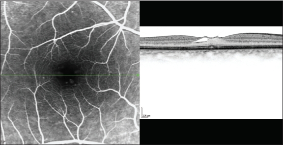 Retinal Physician | PentaVision