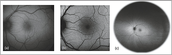 Retinal Physician | PentaVision