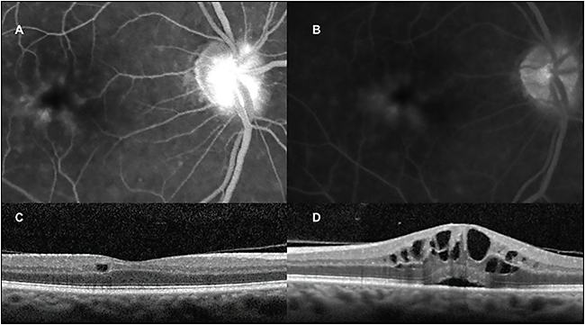 Retinal Physician | PentaVision