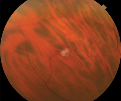 Retinal Physician | PentaVision