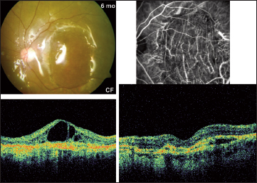 Retinal Physician | PentaVision