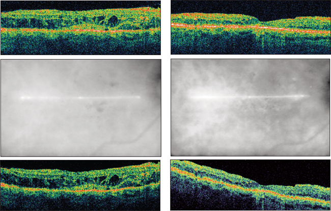 Retinal Physician | PentaVision
