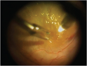 Retinal Physician | PentaVision