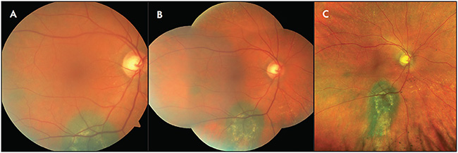 Retinal Physician | PentaVision